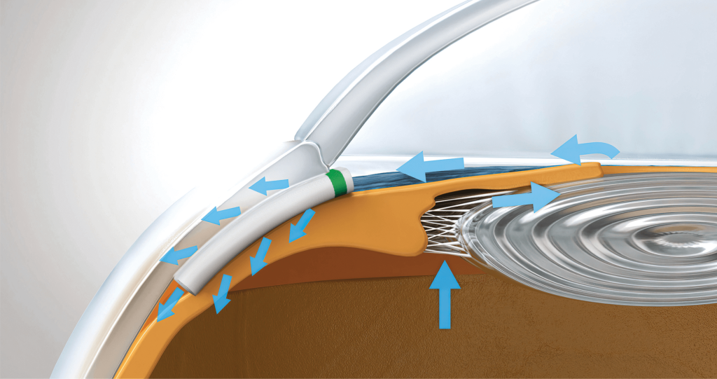 Queensland first glaucoma treatment device | Queensland Eye Institute